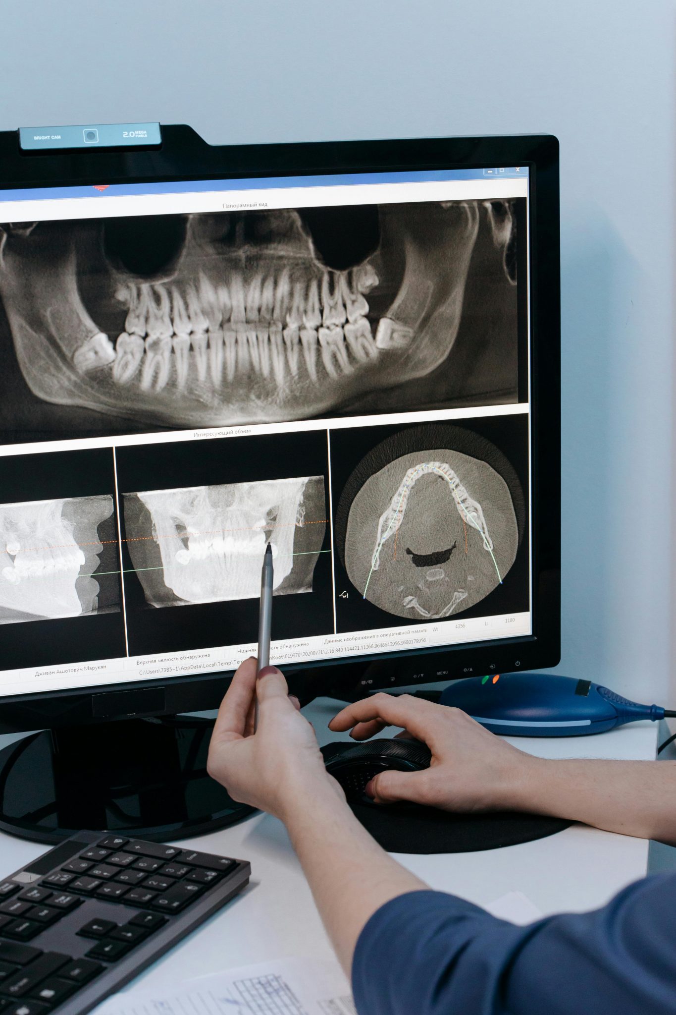 TIPOS DE CARIES DENTALES: IDENTIFICACIÓN Y TRATAMIENTO EFECTIVO ...